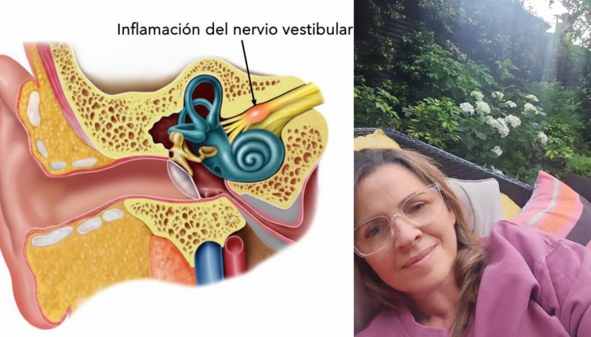 Neuritis vestibular: Qué es, síntomas y tratamiento | TVN